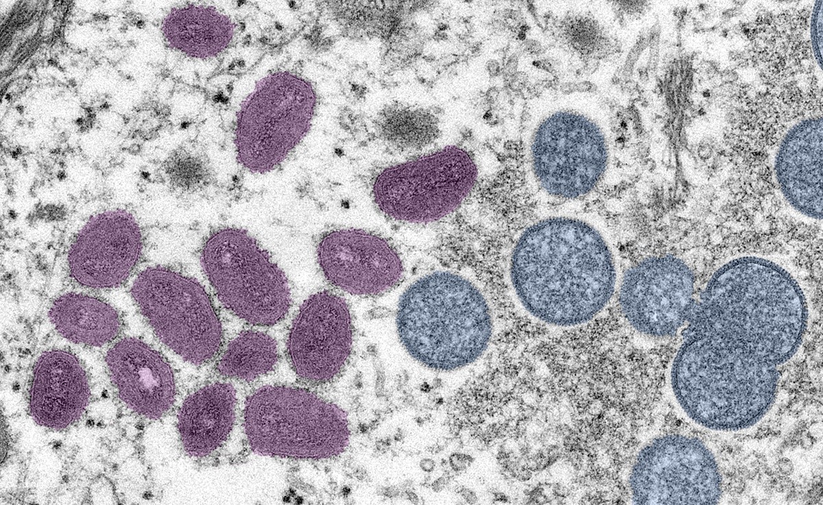 Brasil tem 47 casos de Mpox confirmados em 2026; veja números por ...