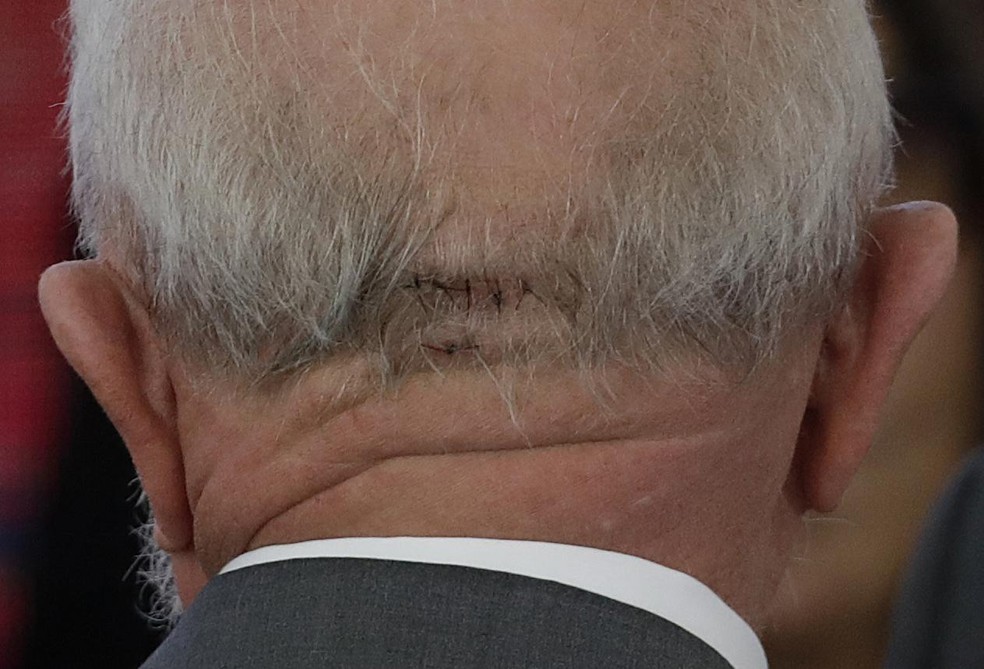 Lula passa por cirurgia: entenda o que é o procedimento realizado e ...